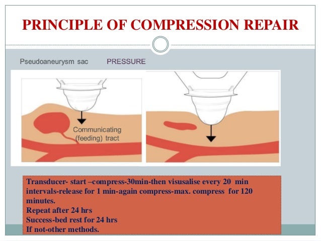 Femoral site psudeoaneurysm