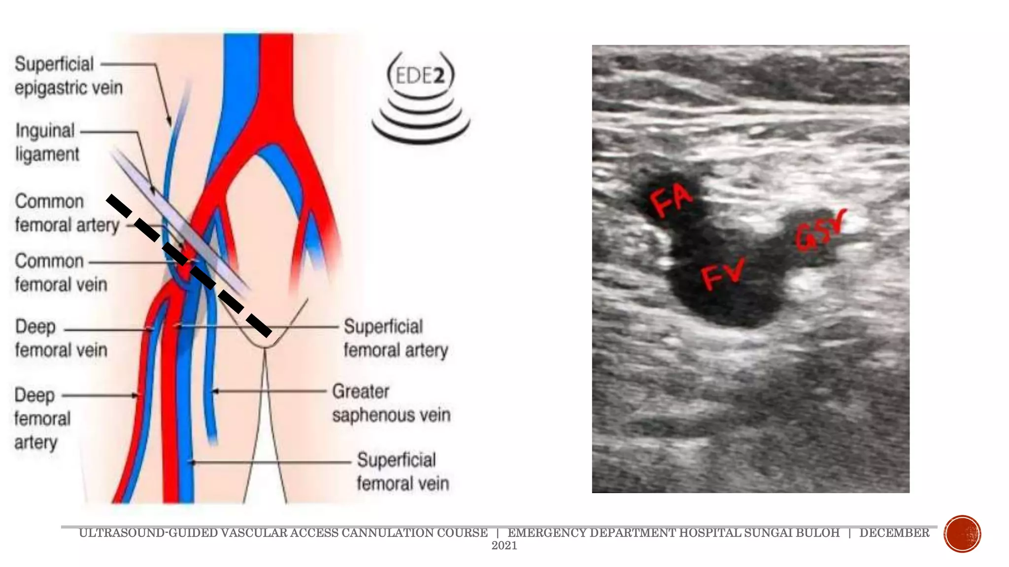 Femoral Vein Cannulation Pptx