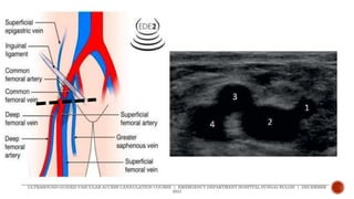 FEMORAL VEIN CANNULATION.pptx