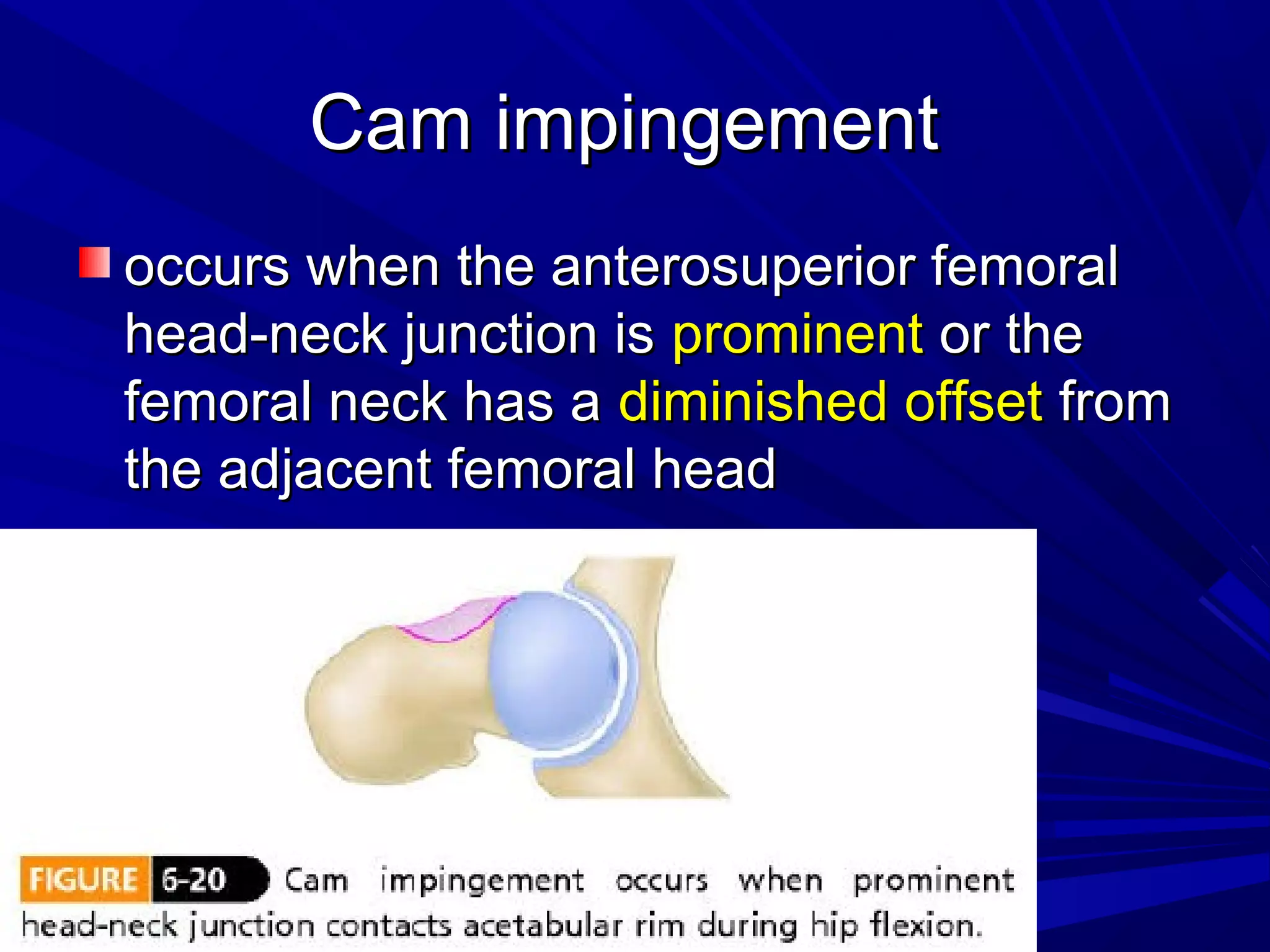 Femoro acetabularimpingementsyndrome-130924081558-phpapp02 | PPT