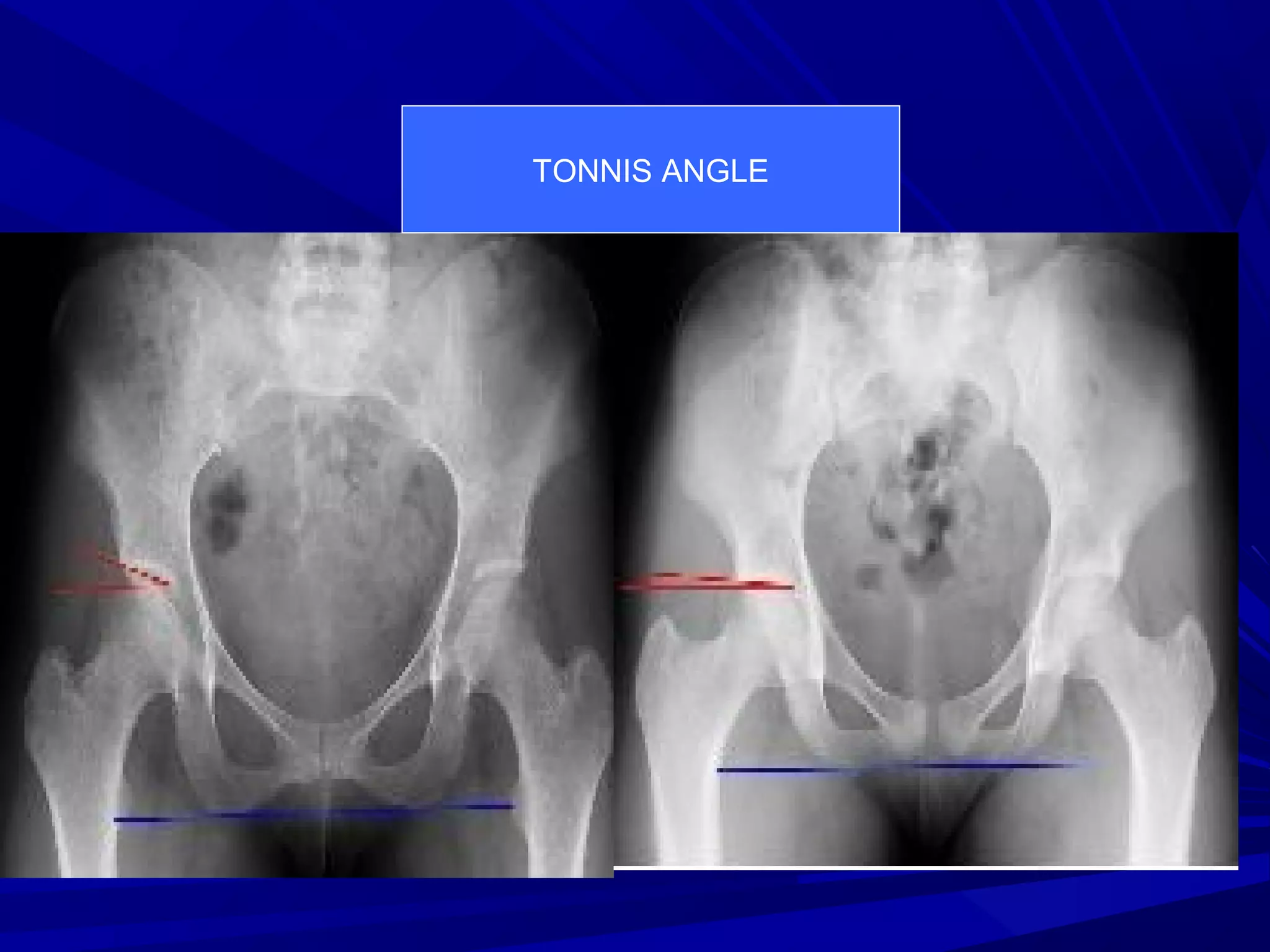 Femoro acetabular impingement syndrome | PPT