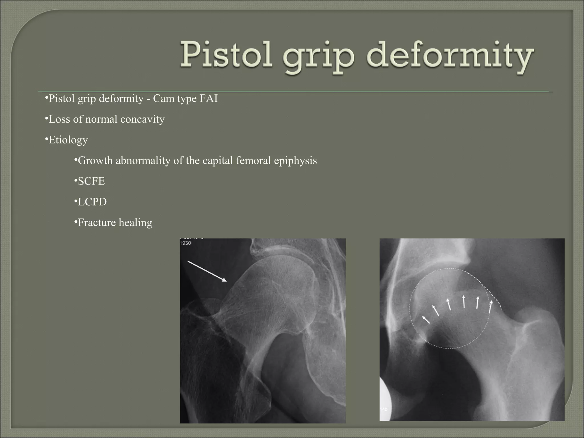 Femoroacetabular%20 impingement[1] | PPT