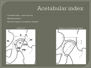 Femoroacetabular%20 impingement[1] | PPT