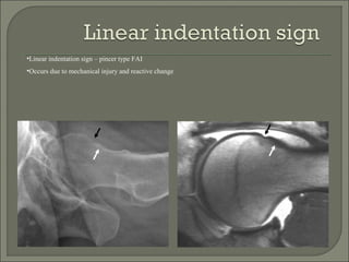 Femoroacetabular%20 impingement[1] | PPT