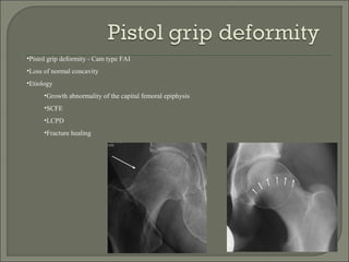 Femoroacetabular%20 impingement[1] | PPT