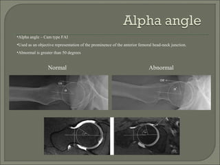 Femoroacetabular%20 impingement[1] | PPT