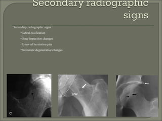 Femoroacetabular%20 impingement[1] | PPT