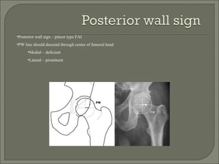 Femoroacetabular%20 impingement[1] | PPT