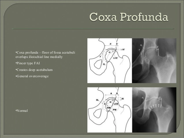 Femoroacetabular%20 impingement[1]