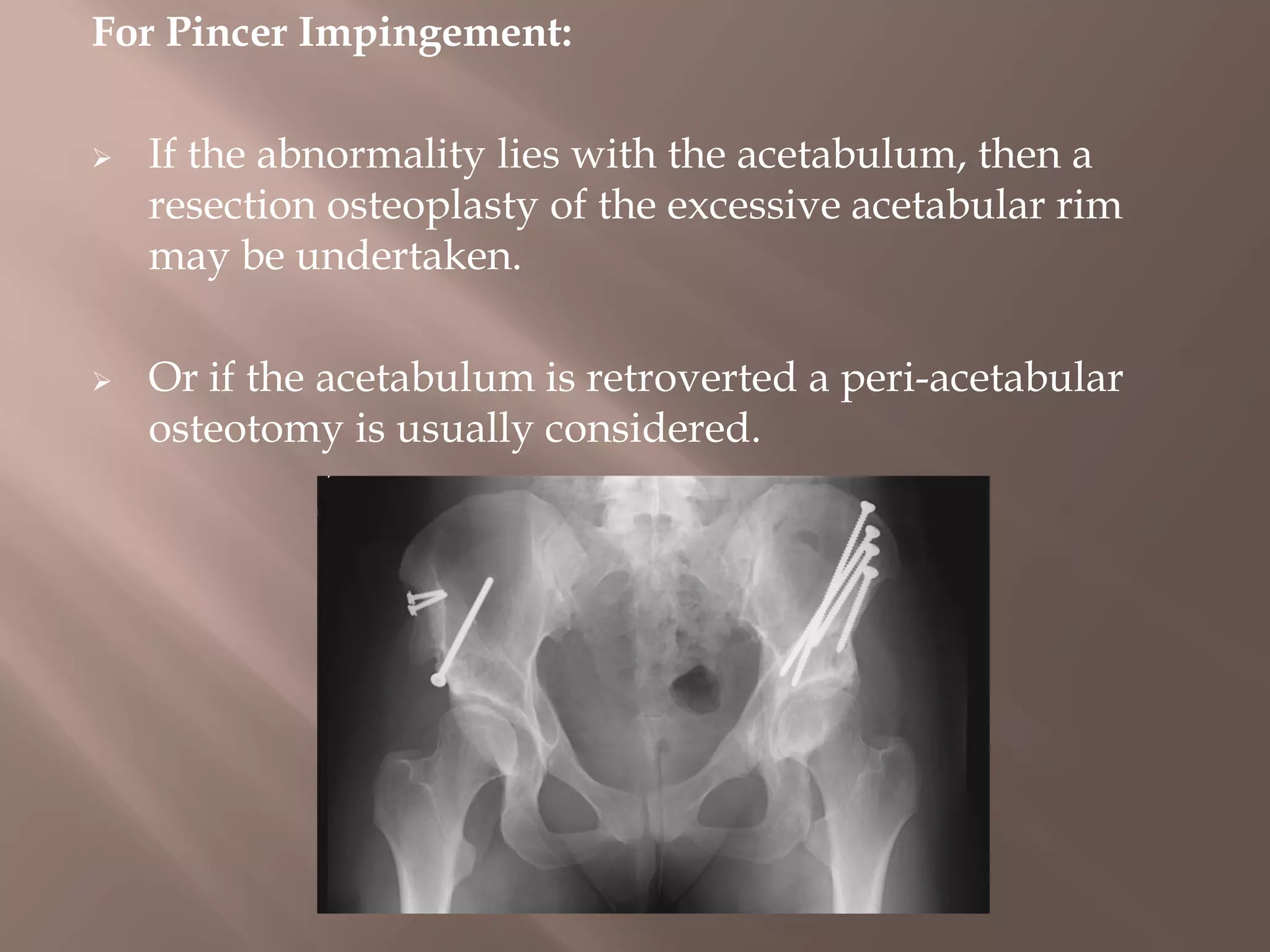 Femoroacetabular impingement | PDF