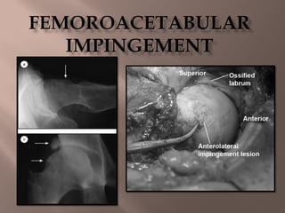 Femoroacetabular impingement | PDF