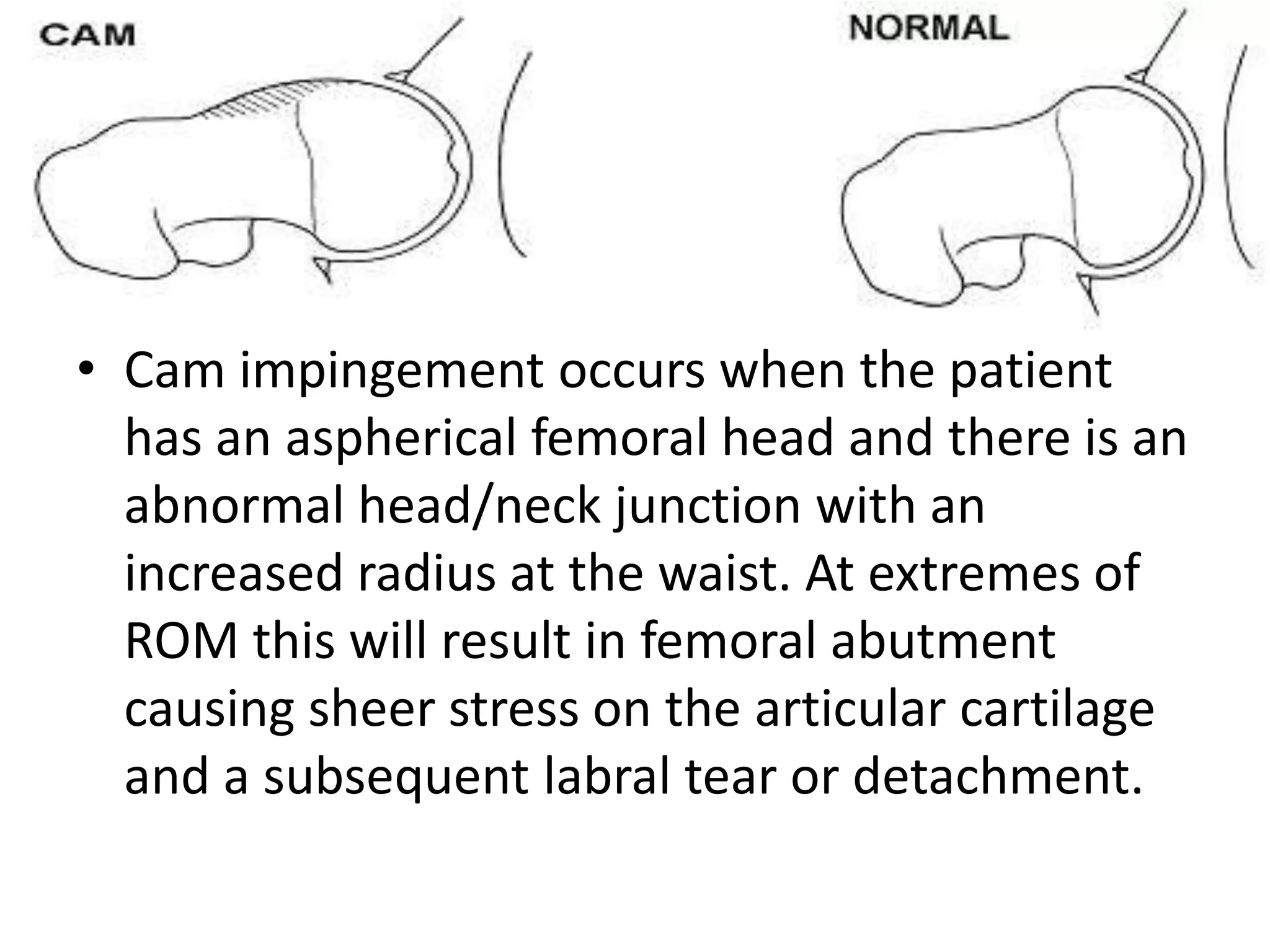 Femoroacetabular impingement | PPTX