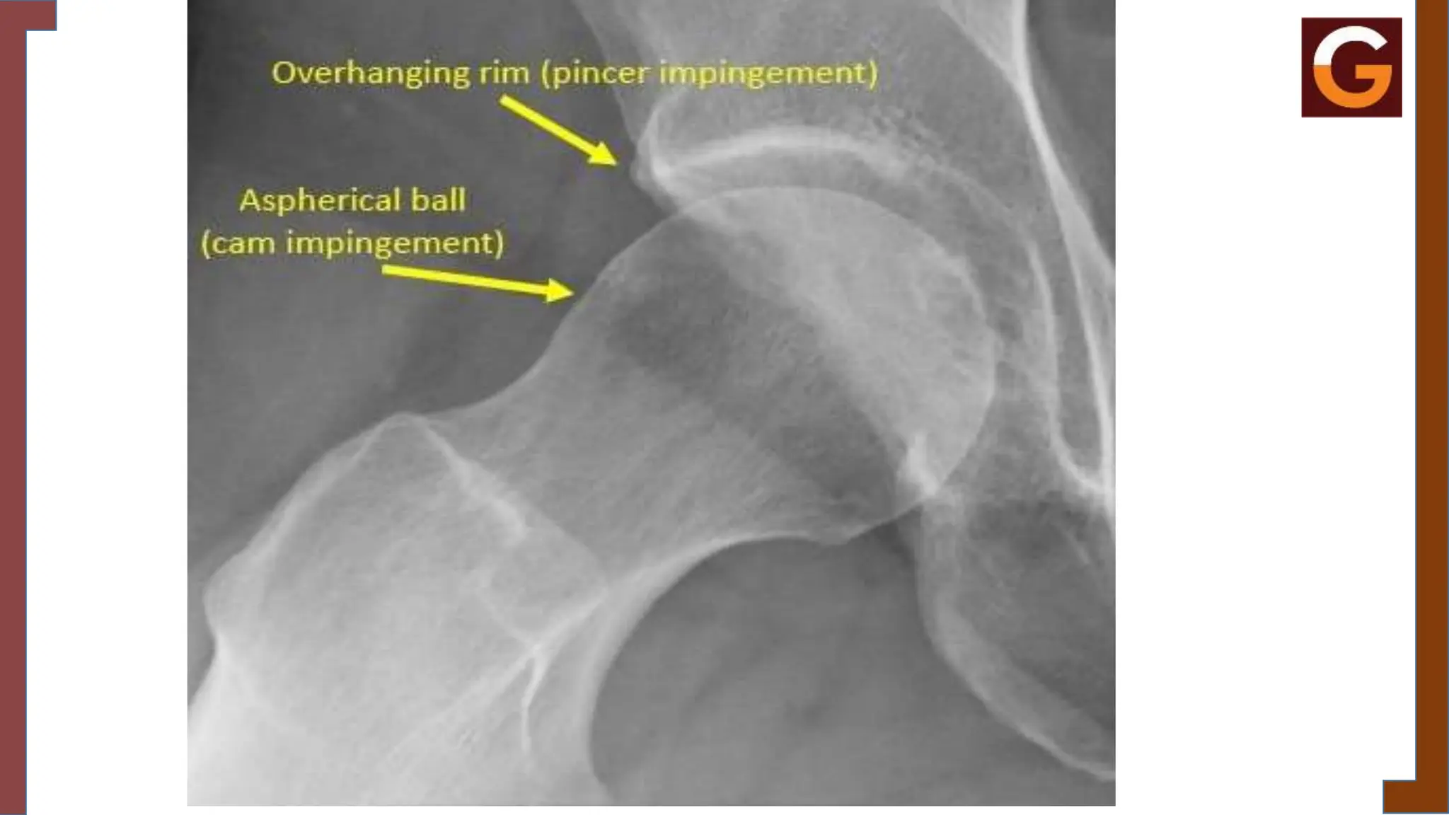 definition of Femoroacetabular impingement.pptx