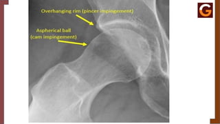 definition of Femoroacetabular impingement.pptx
