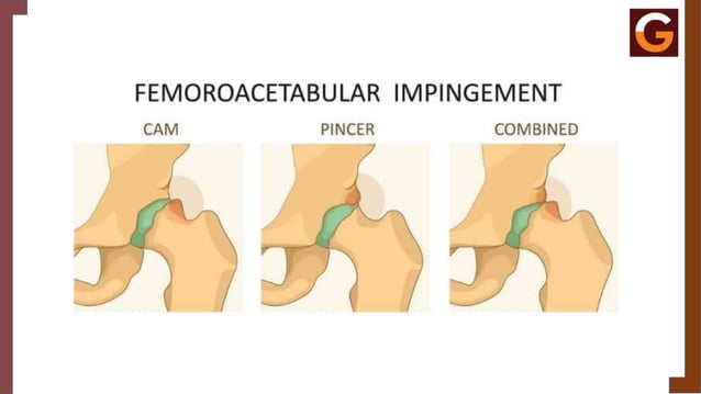 definition of Femoroacetabular impingement.pptx