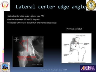 Femoroacetabular impingement (FAI) | PPT