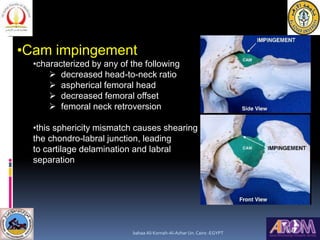 Femoroacetabular impingement (FAI) | PPT