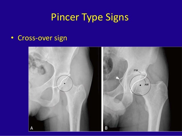 Femoroacetabular impingement syndrome