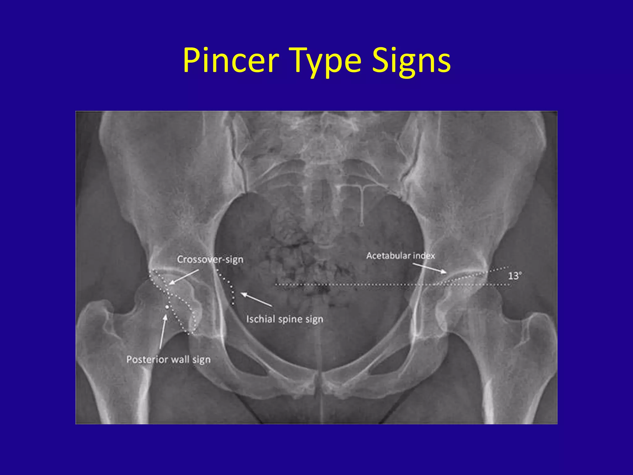 Femoroacetabular impingement syndrome | PPTX