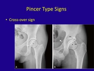 Femoroacetabular impingement syndrome | PPTX
