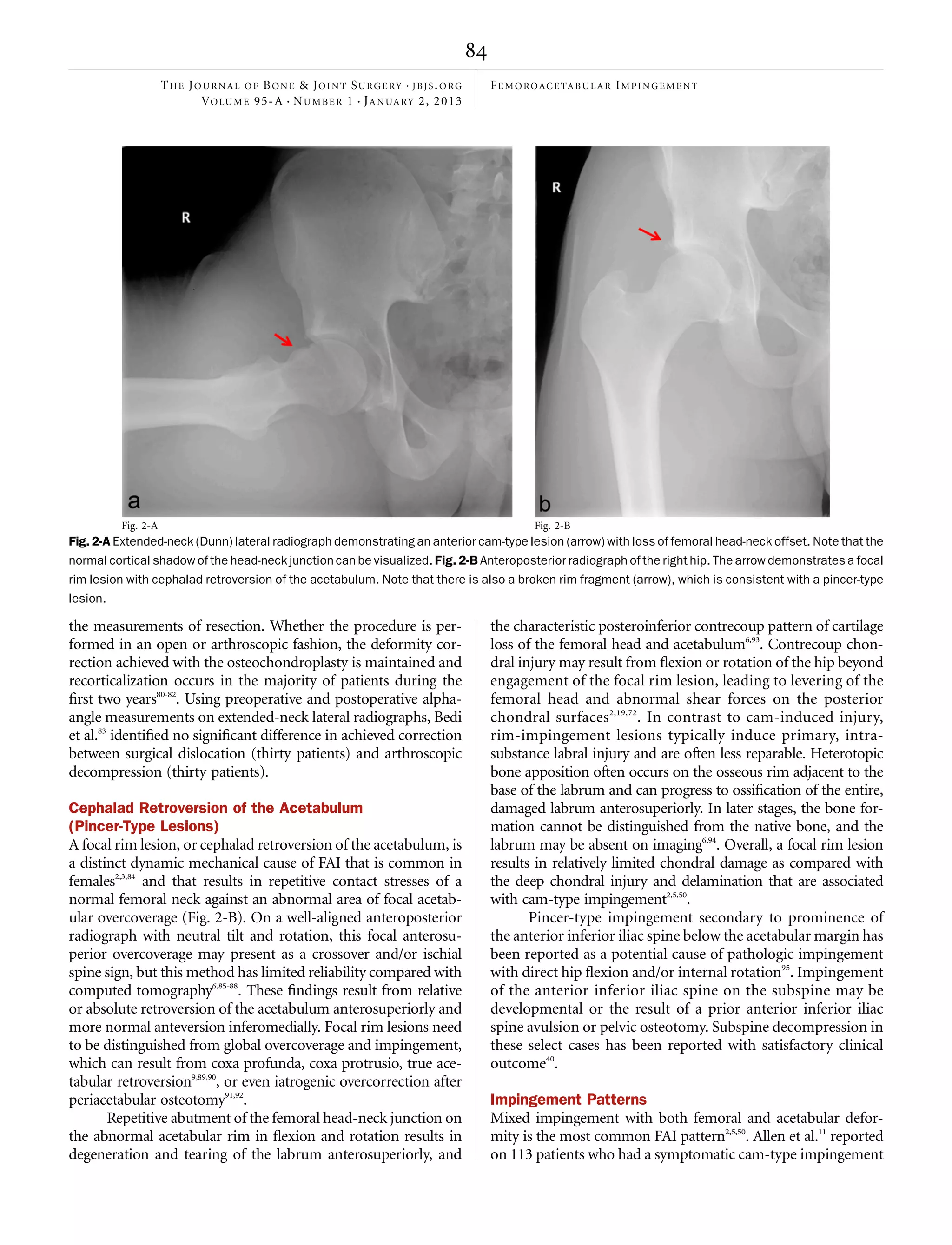 Femoroactabular impingement | PDF