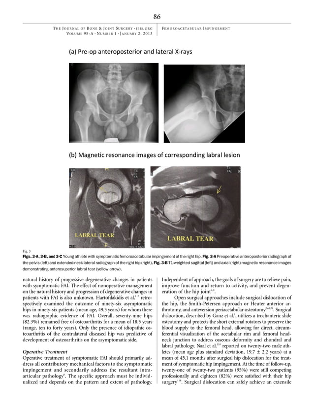 Femoroactabular impingement | PDF