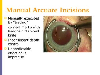 FemtoCataract Surgery - Is this the Future? | PPT