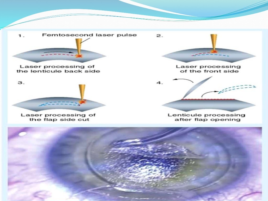Lensar Femtosecond Laser