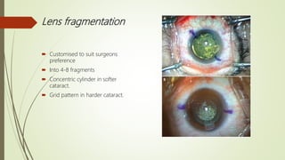 Femtosecond laser assisted cataract surgery | PPTX