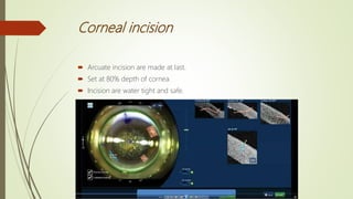 Femtosecond laser assisted cataract surgery | PPTX