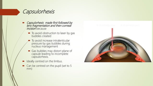 Femtosecond laser assisted cataract surgery