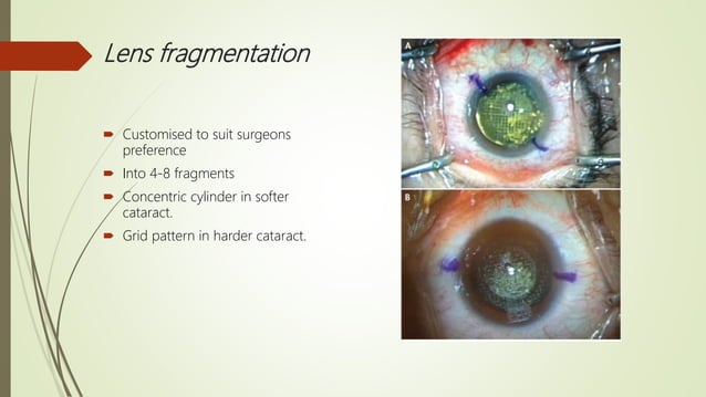 Femtosecond laser assisted cataract surgery