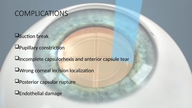 FEMTOSECOND LASER CATARACT SURGERY IN OPTOMETRY.pptx
