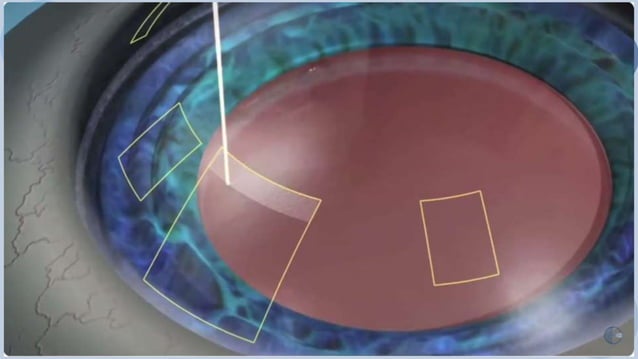 USE OF FEMTOSECOND LASERS IN EYE SURGERY | PPTX | Eye and Vision ...