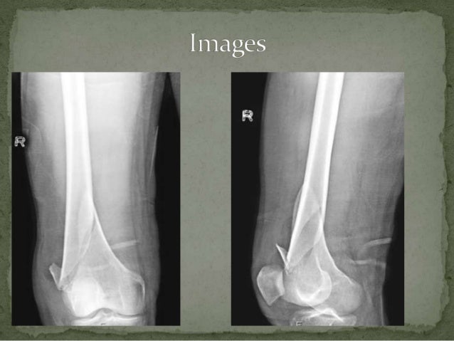 Supracondylar Femur Fracture