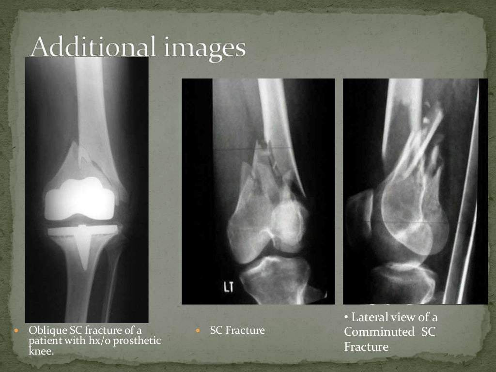 Supracondylar Femur Fracture