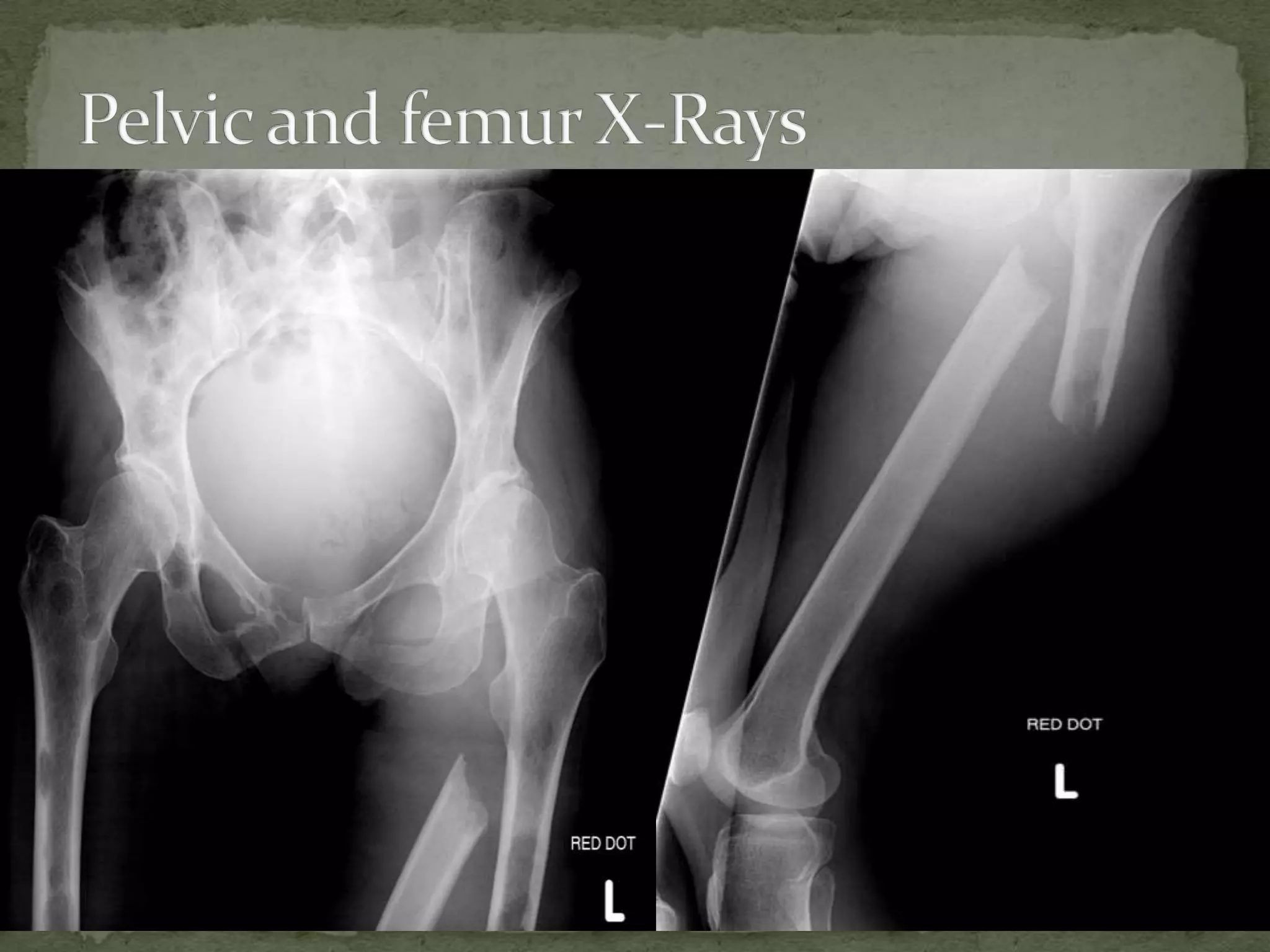 Pathologic Femur Fracture Ppt