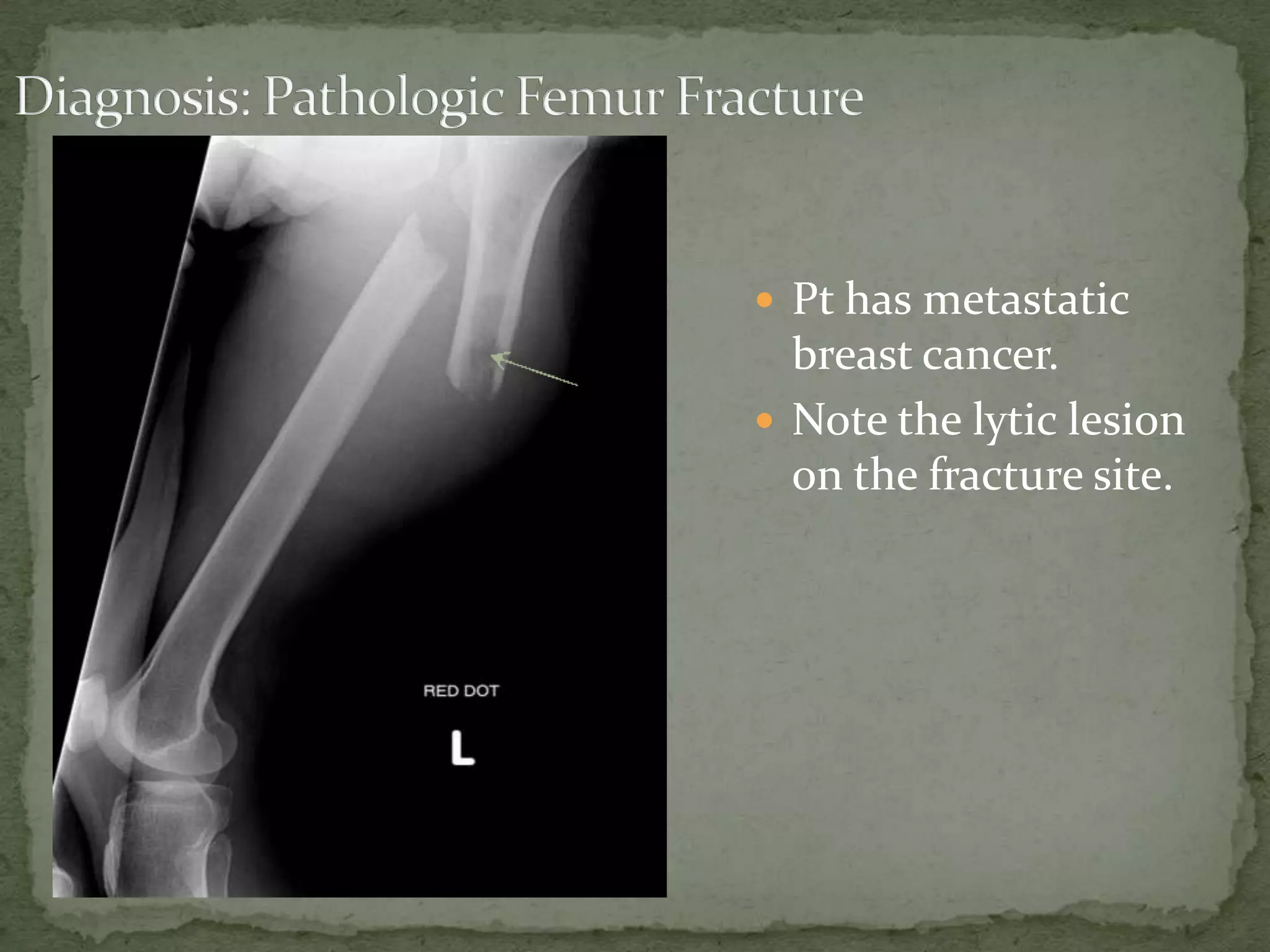 Pathologic Femur Fracture | PPT