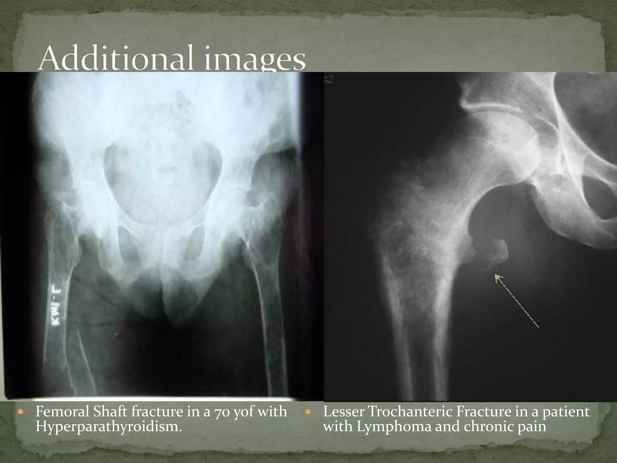 Pathologic Femur Fracture | PPT