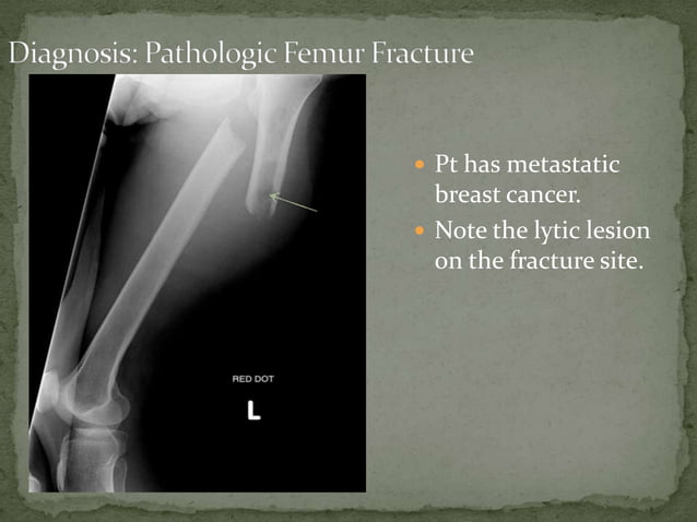 Pathologic Femur Fracture Ppt