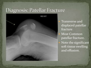 Patellar Fracture | PPT