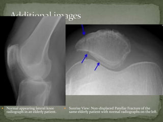 Patella Fracture Sunrise