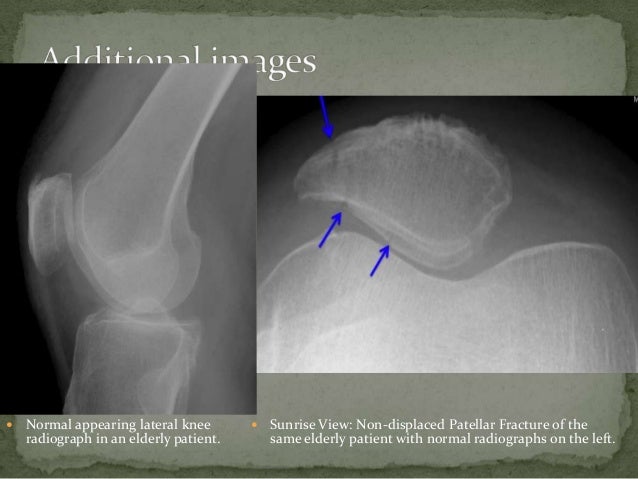 Patellar Avulsion Fracture