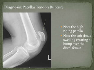 Patellar Tendon Rupture | PPTX
