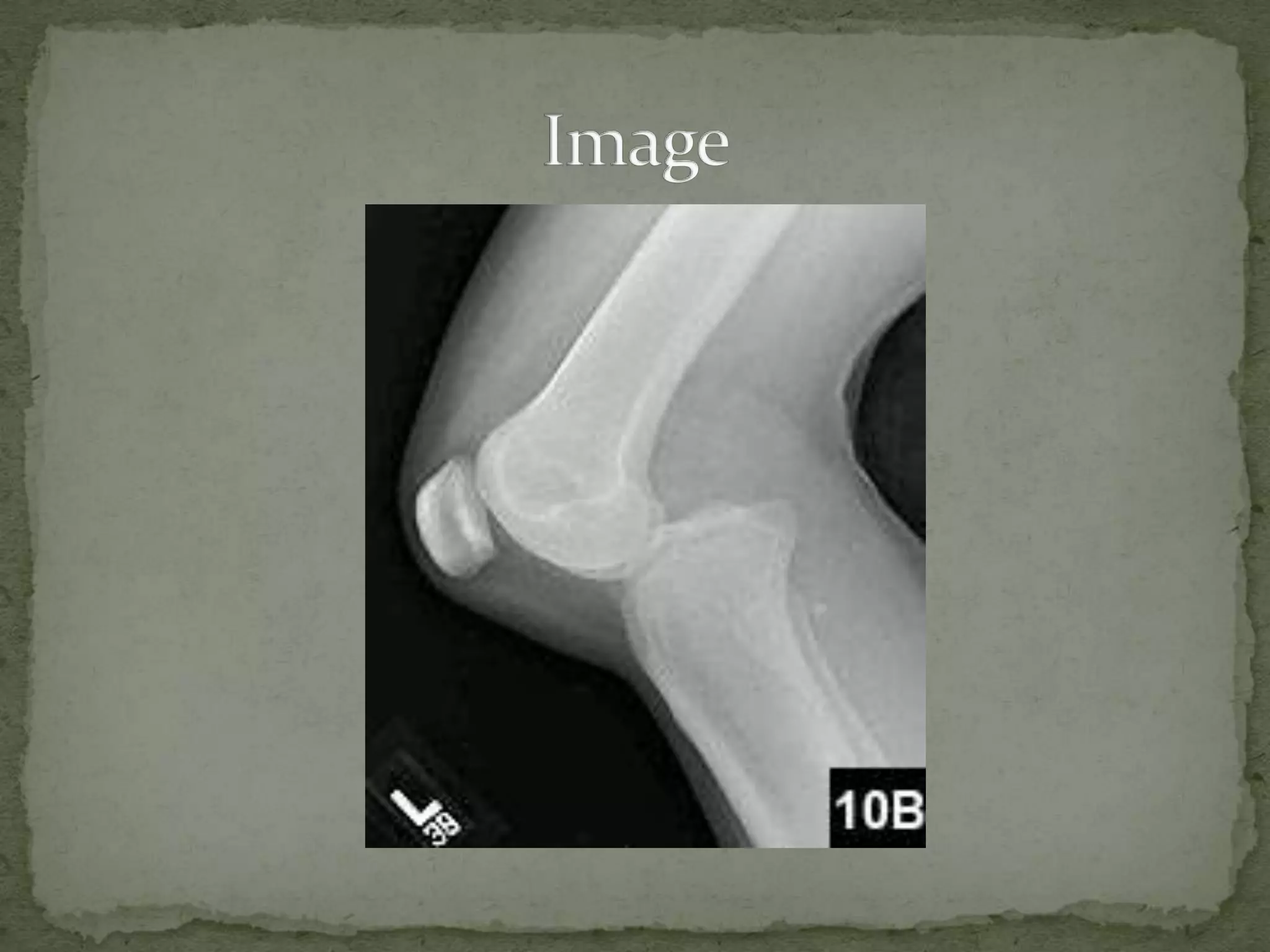 Posterior Knee Dislocation | PPTX