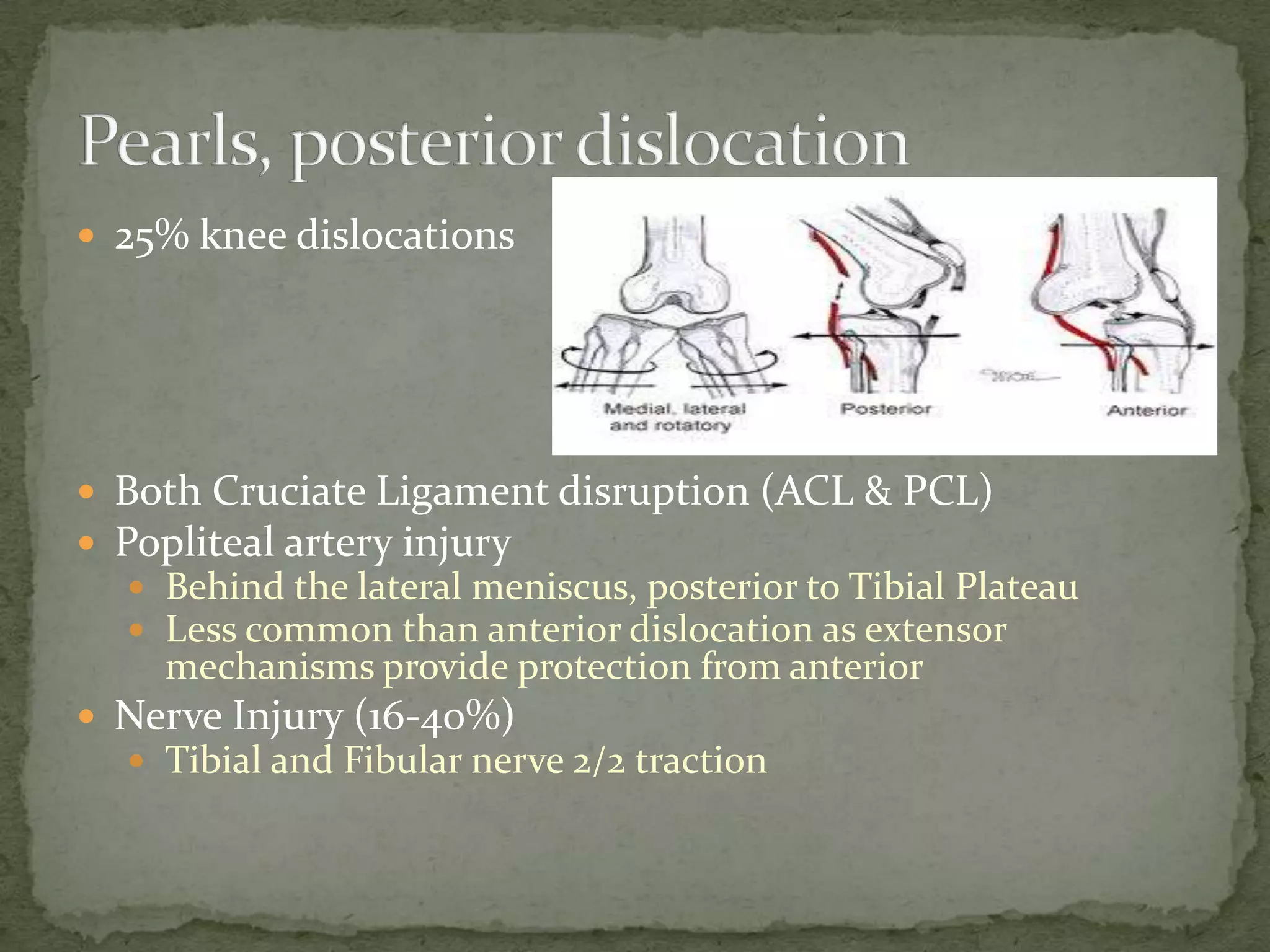 Posterior Knee Dislocation | PPTX