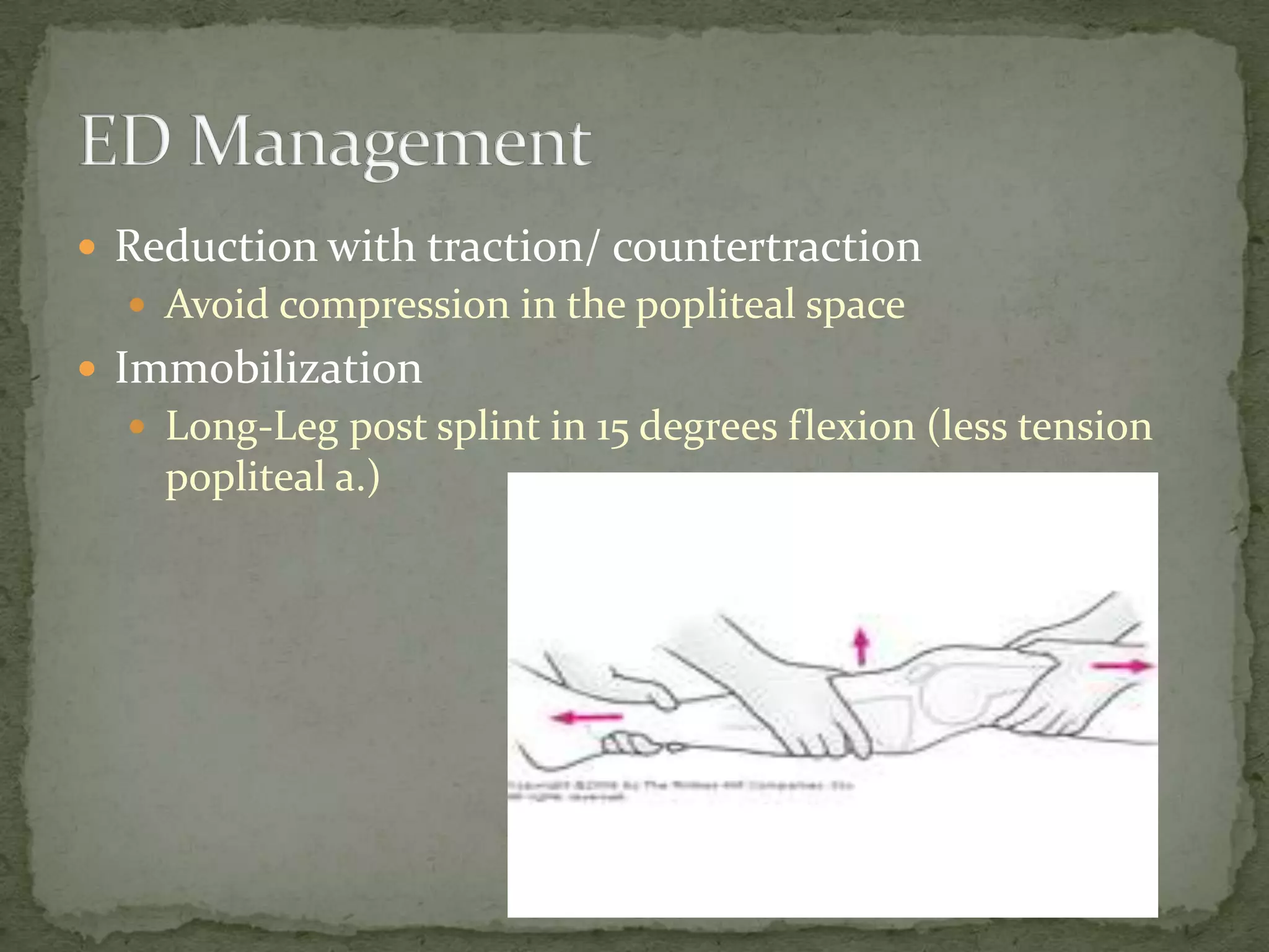 Posterior Knee Dislocation | PPTX