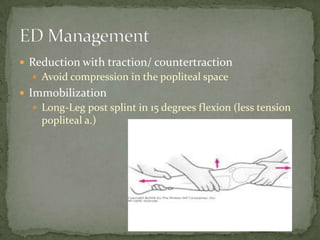 Posterior Knee Dislocation | PPT