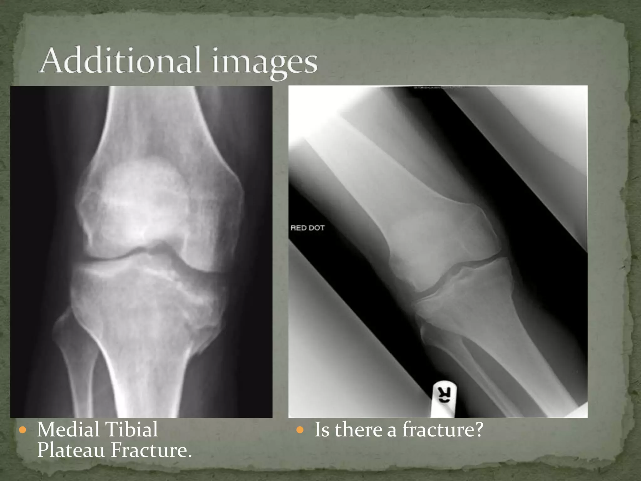 Tibial Plateau Fracture Pptx