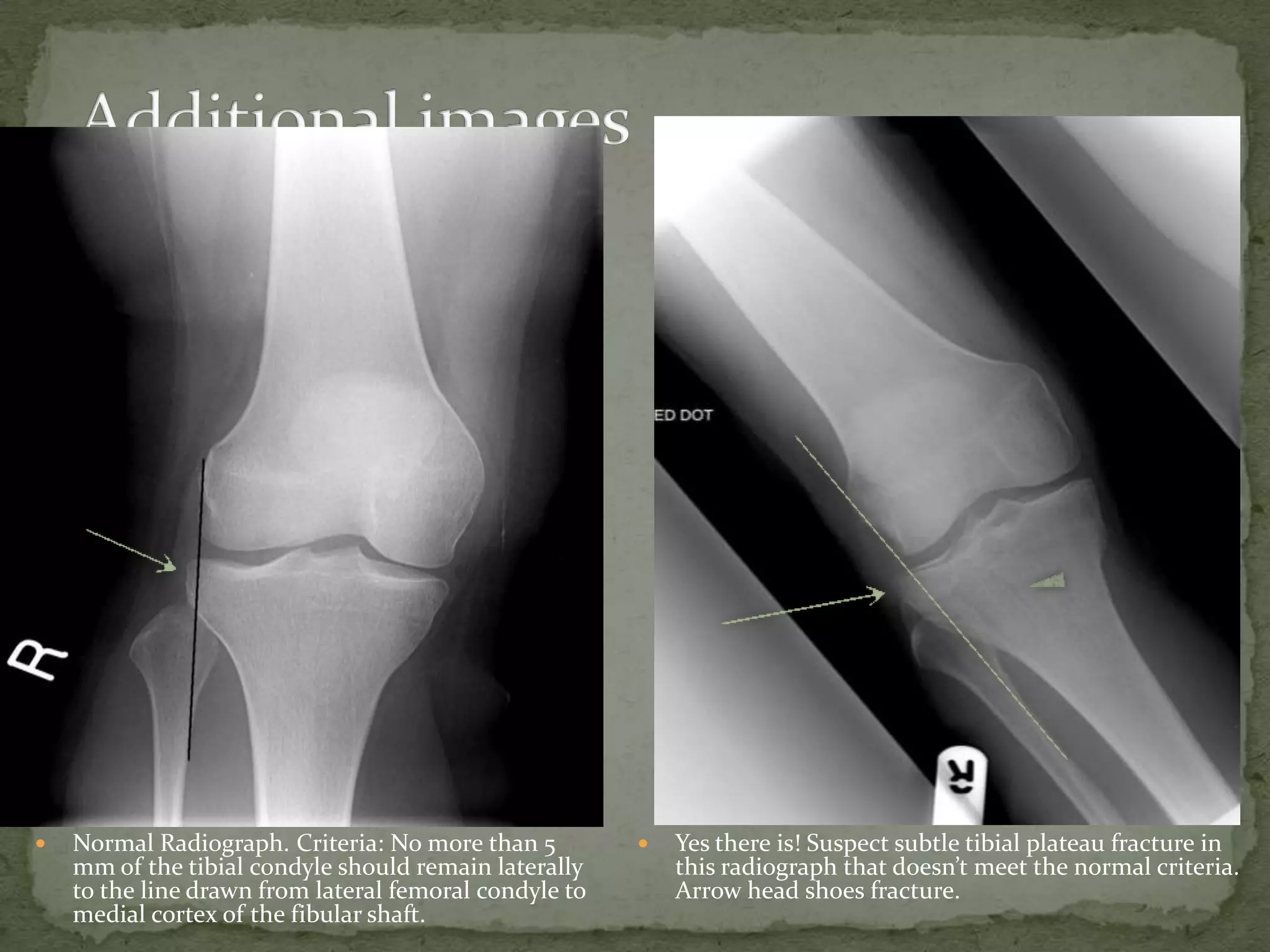 Tibial Plateau Fracture | PPTX | Death, Injury, or Military Conflict ...